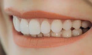 Transform Your Smile with Porcelain Veneers in Texas | Dental Plus Clinic